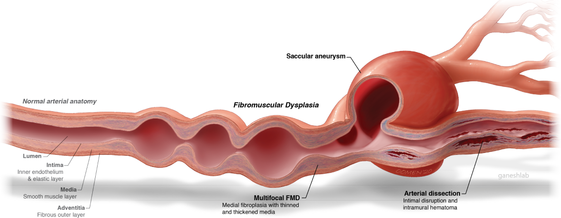 FMD & Arterial Dissection Clinic » The Texas Heart Institute