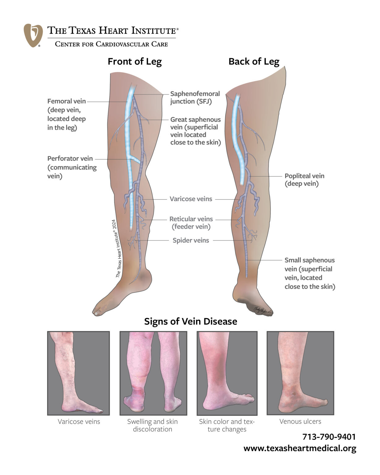 Vein Clinic » The Texas Heart Institute