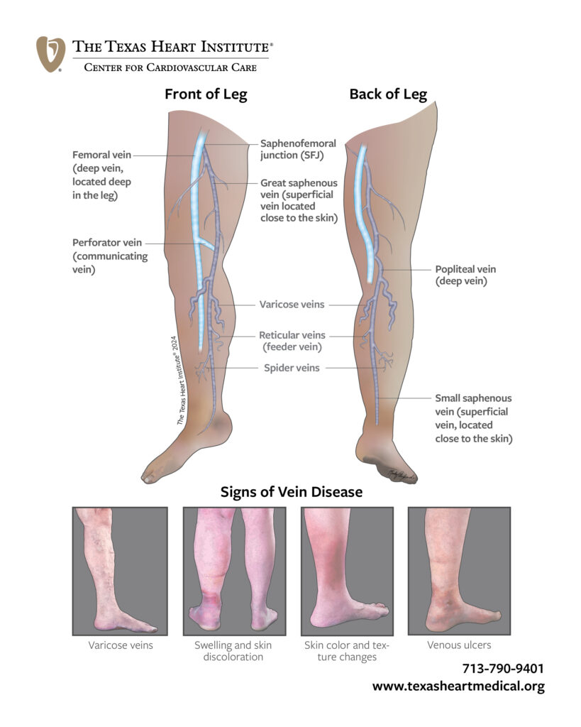 Vein Clinic » The Texas Heart Institute